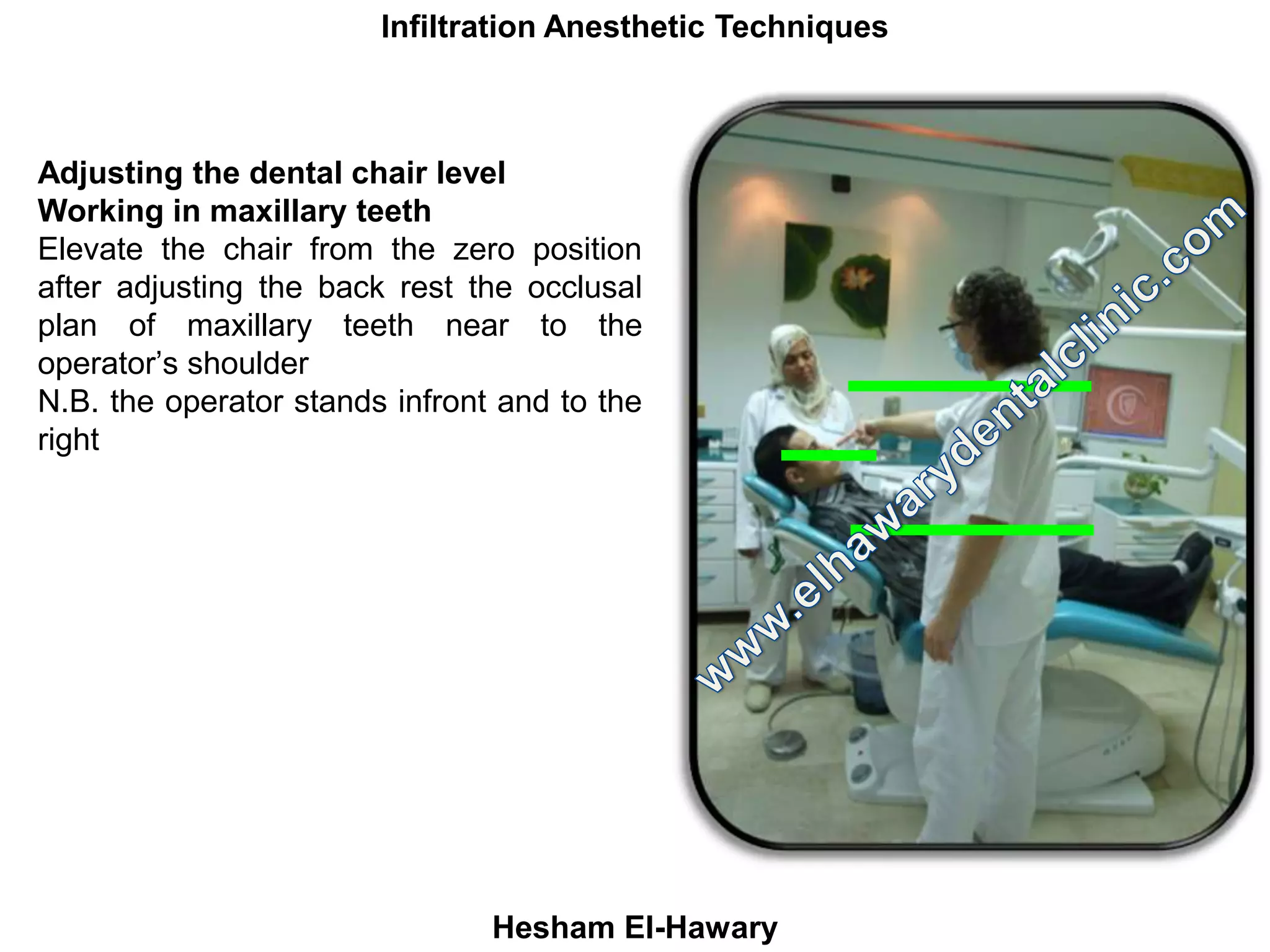 Maxillary infiltration anesthetic techniques (with photos)