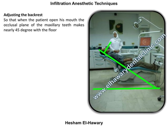 Maxillary infiltration anesthetic techniques (with photos) | PPTX ...