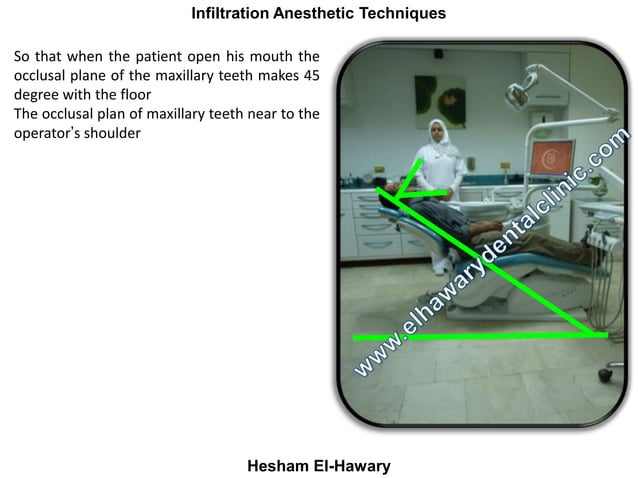 Maxillary infiltration anesthetic techniques (with photos) | PPTX ...