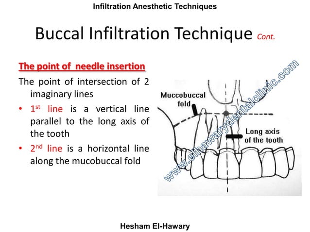 Maxillary infiltration anesthetic techniques (with photos) | PPTX ...