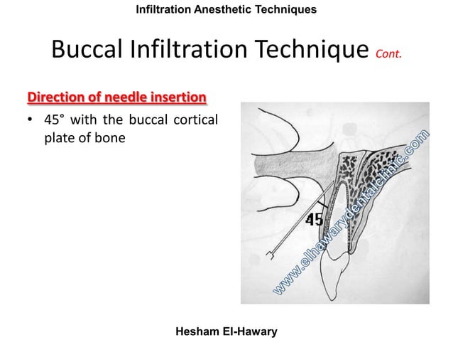 Maxillary infiltration anesthetic techniques (with photos) | PPTX ...