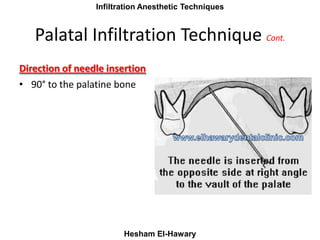 Maxillary infiltration anesthetic techniques (with photos) | PPTX