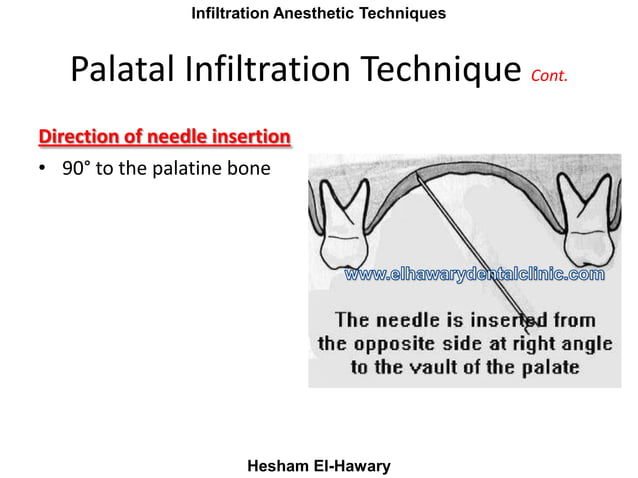 Maxillary infiltration anesthetic techniques (with photos) | PPTX ...