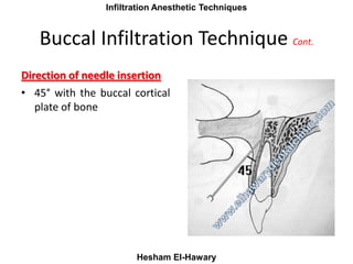 Maxillary infiltration anesthetic techniques (with photos)