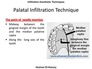 Maxillary infiltration anesthetic techniques (with photos) | PPT