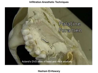 Maxillary infiltration anesthetic techniques (with photos)