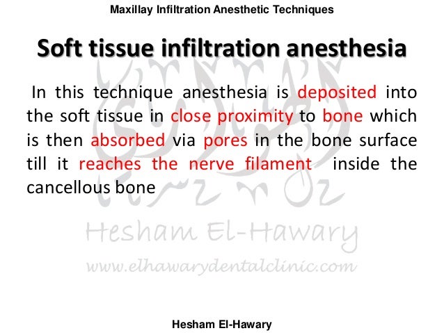 Maxillary infiltration anesthetic techniques (with photos)