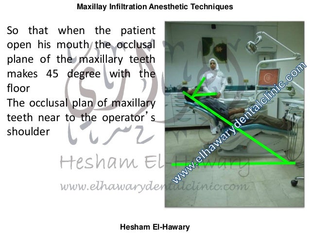 Maxillary infiltration anesthetic techniques (with photos)