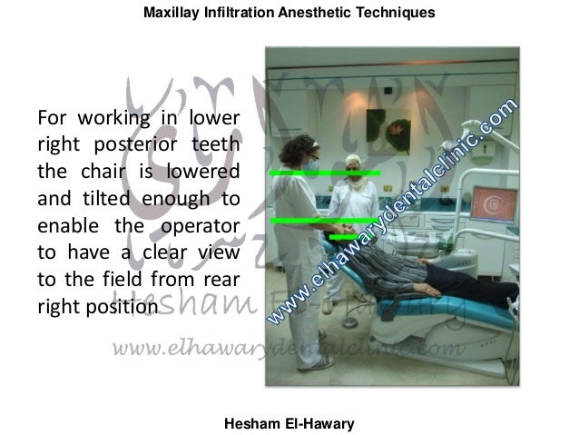Maxillary infiltration anesthetic techniques (with photos)