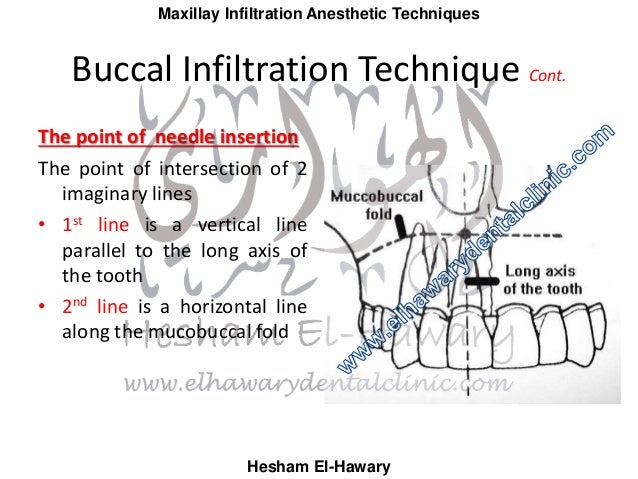 Maxillary infiltration anesthetic techniques (with photos)