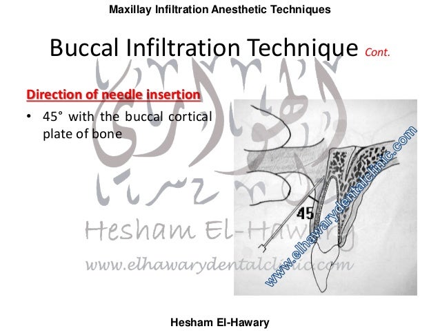 Maxillary infiltration anesthetic techniques (with photos)