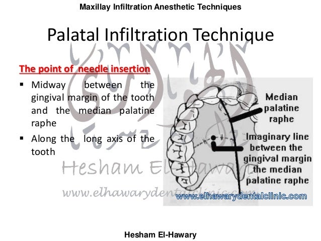 Maxillary infiltration anesthetic techniques (with photos)