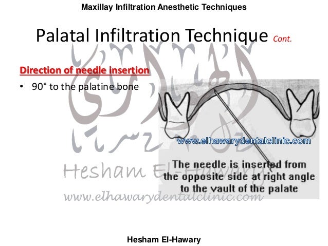 Maxillary infiltration anesthetic techniques (with photos)