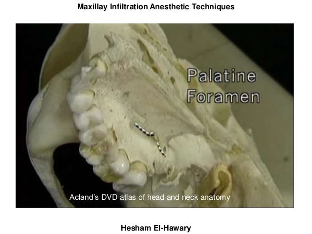 Maxillary infiltration anesthetic techniques (with photos)