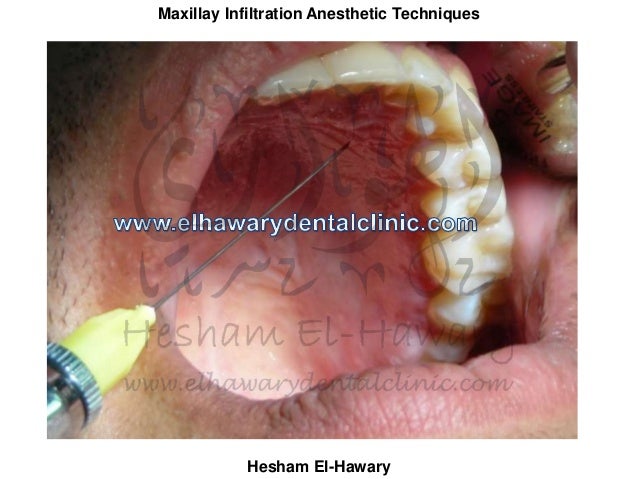 Maxillary infiltration anesthetic techniques (with photos)