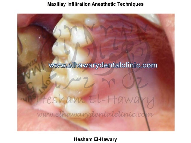 Maxillary infiltration anesthetic techniques (with photos)