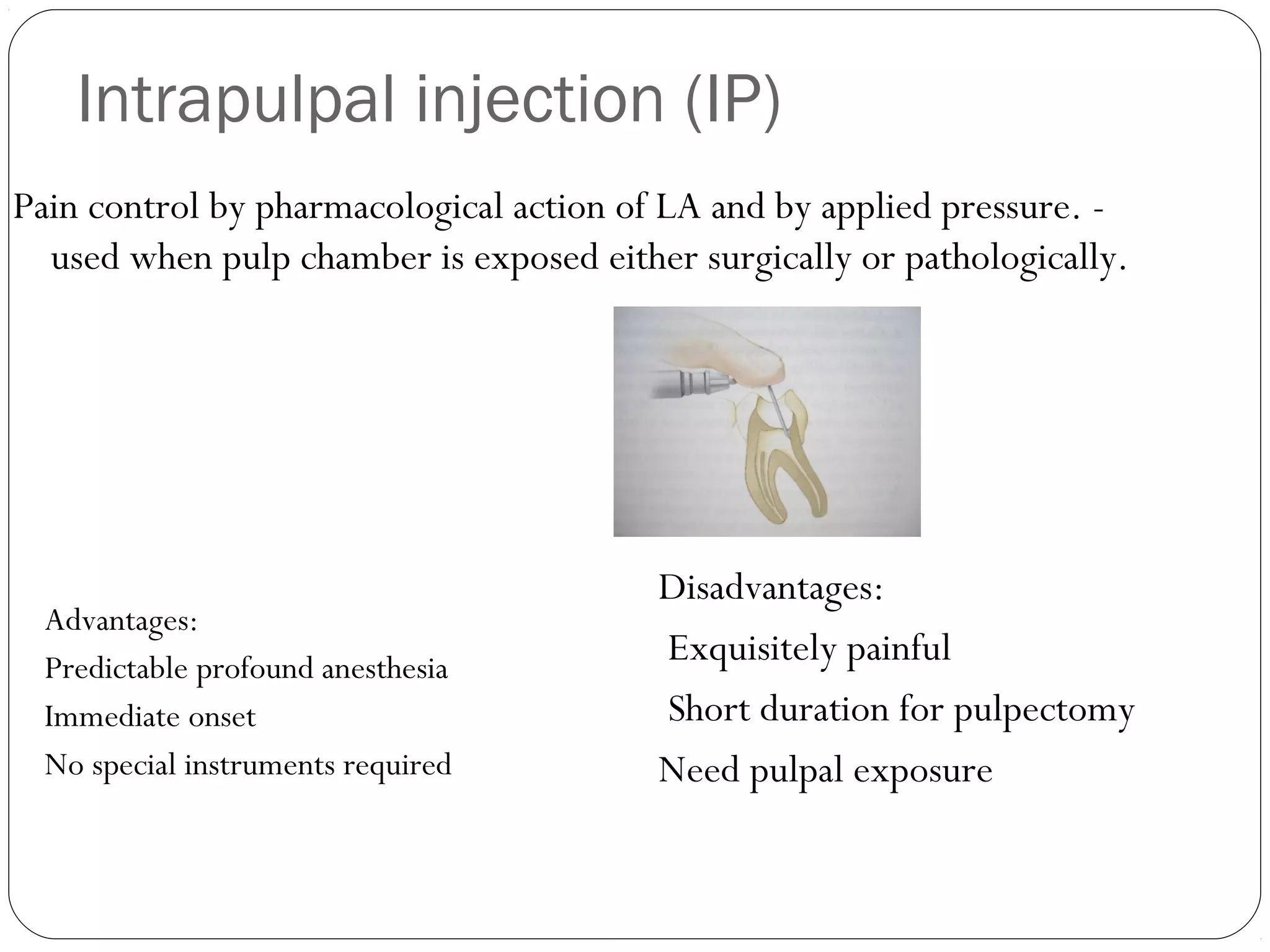Maxillary injection techniques | PPT