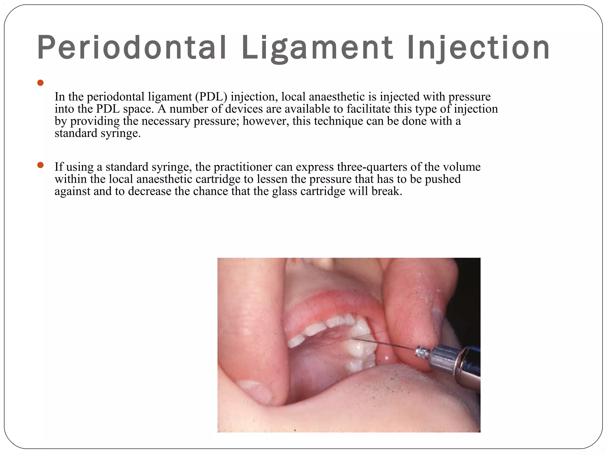 Maxillary injection techniques | PPT