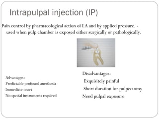Maxillary injection techniques | PPT