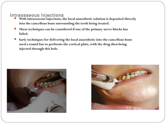 Maxillary injection techniques | PPT