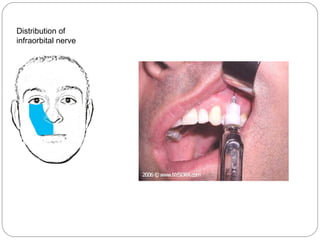 Maxillary injection techniques | PPT