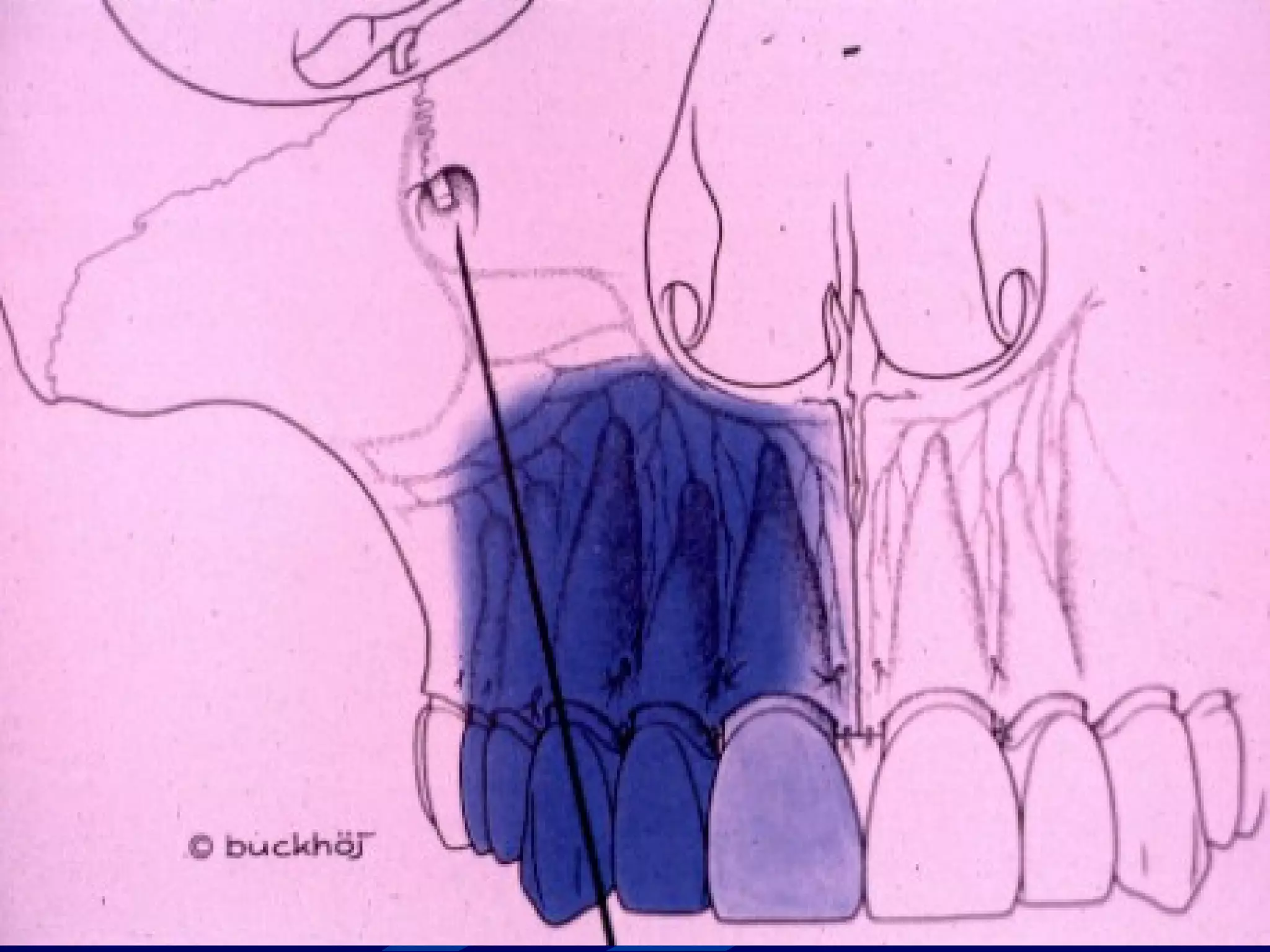 Maxillary Local Anesthesia | PPT