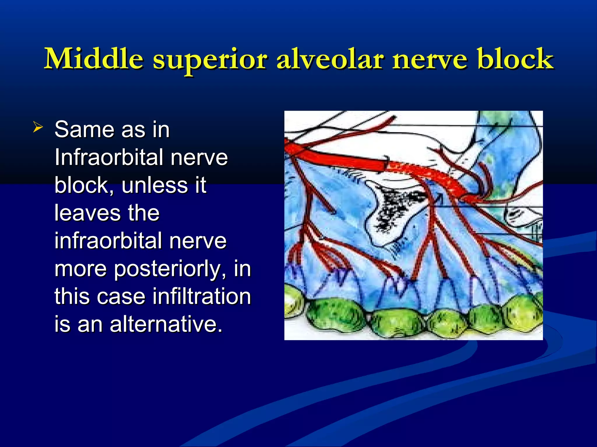 Maxillary Local Anesthesia | PPT