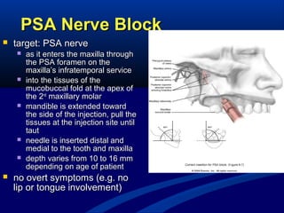Maxillary Local Anesthesia | PPT