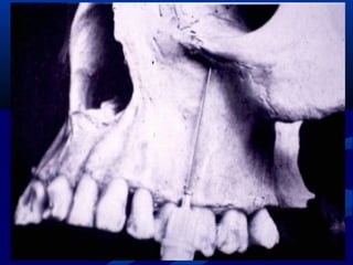 Maxillary Local Anesthesia | PPT