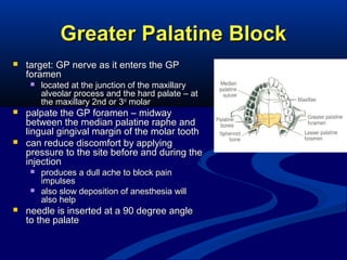 Maxillary Local Anesthesia | PPT