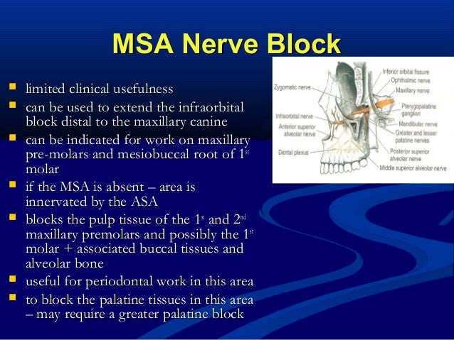 Maxillary Local Anesthesia