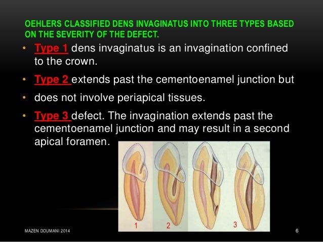 Maxillary lateral incisor
