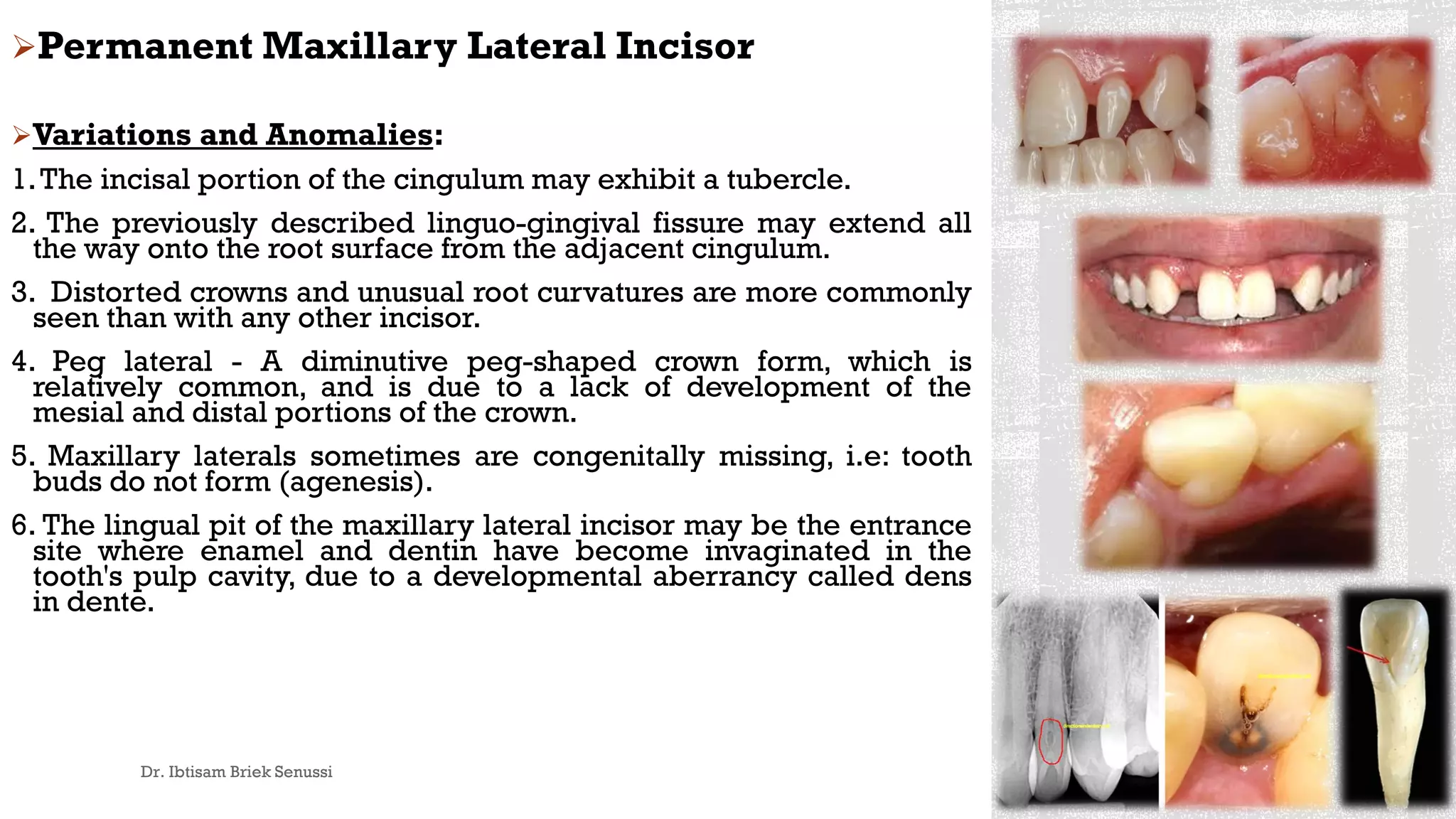 Maxillary lateral incisor. | PDF