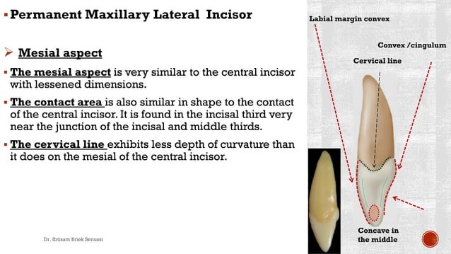 Maxillary lateral incisor. | PDF | Dental Health | Diseases and Conditions