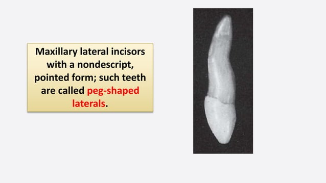 Permanent Maxillary Lateral Incisors-Dr Saba Arshad | PPT