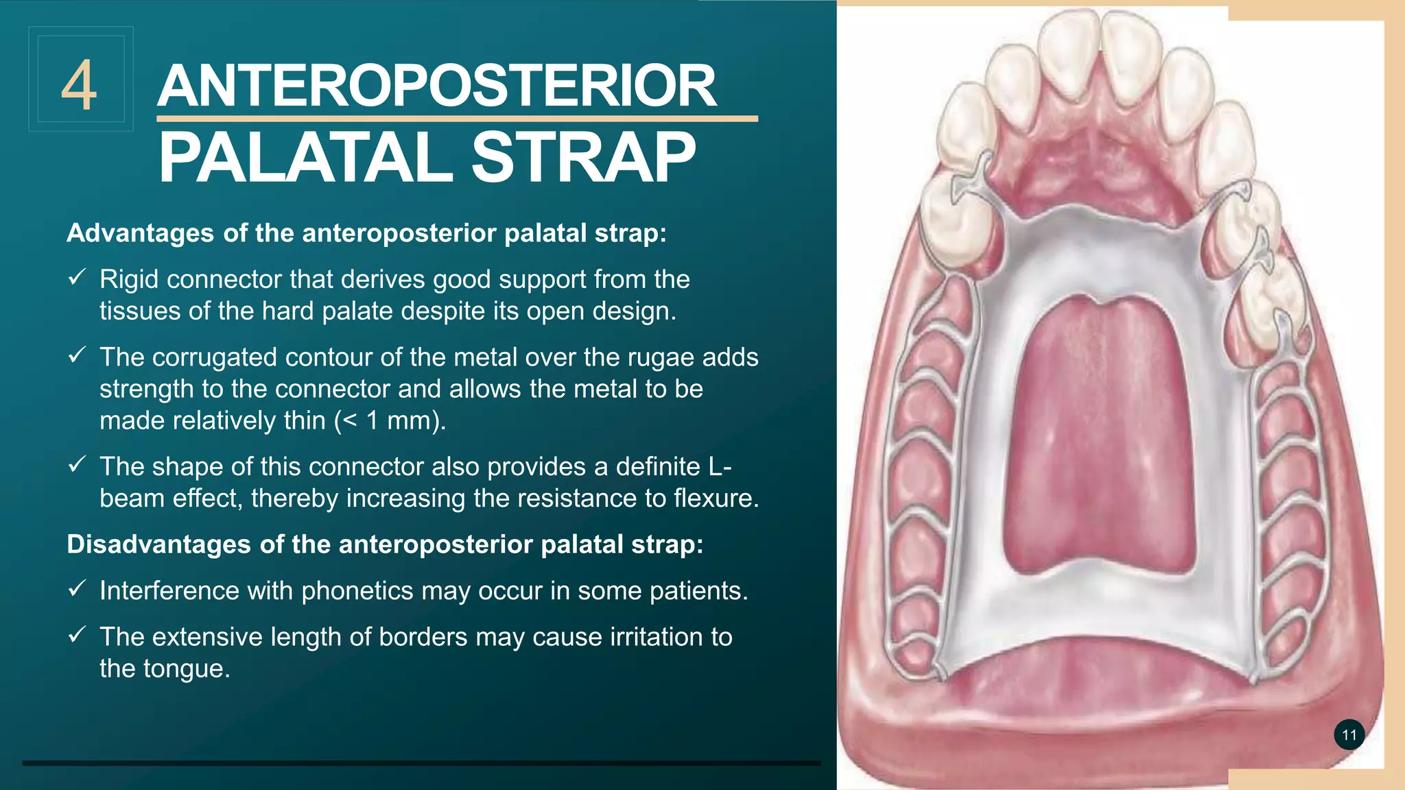 Maxillary major connectors by mohammed hekma | PPTX
