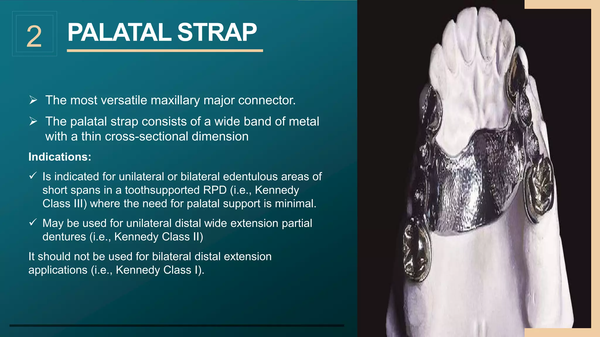Maxillary major connectors by mohammed hekma | PPTX