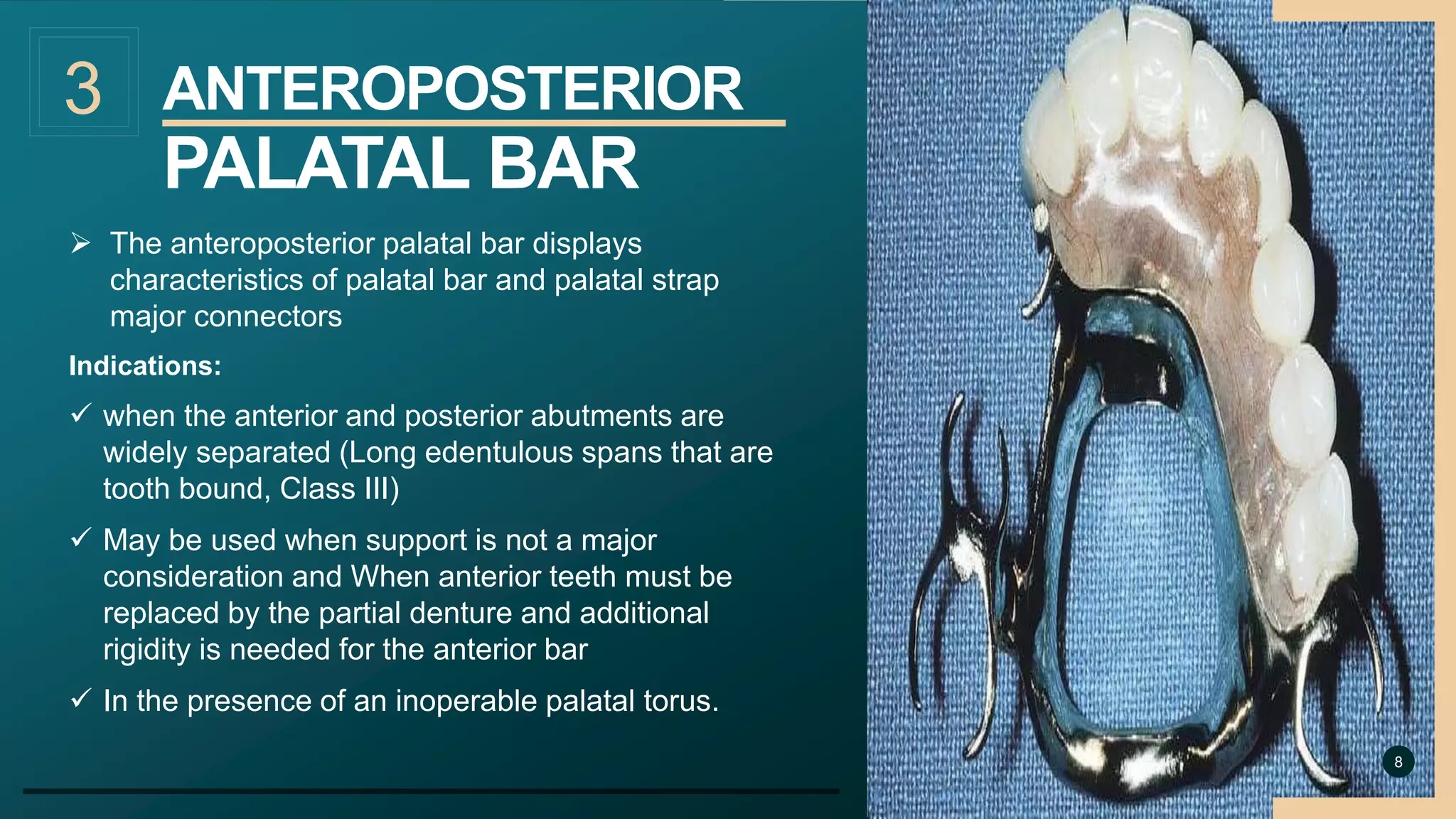 Maxillary major connectors by mohammed hekma | PPTX