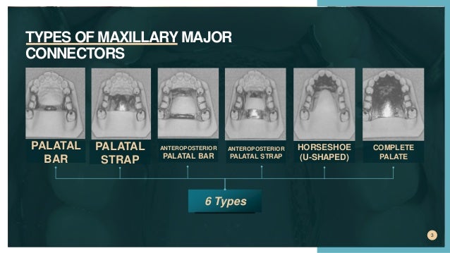Maxillary major connectors by mohammed hekma