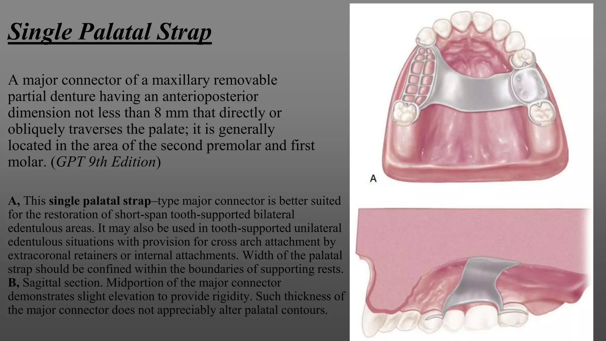 Maxillary major connectors | PPTX