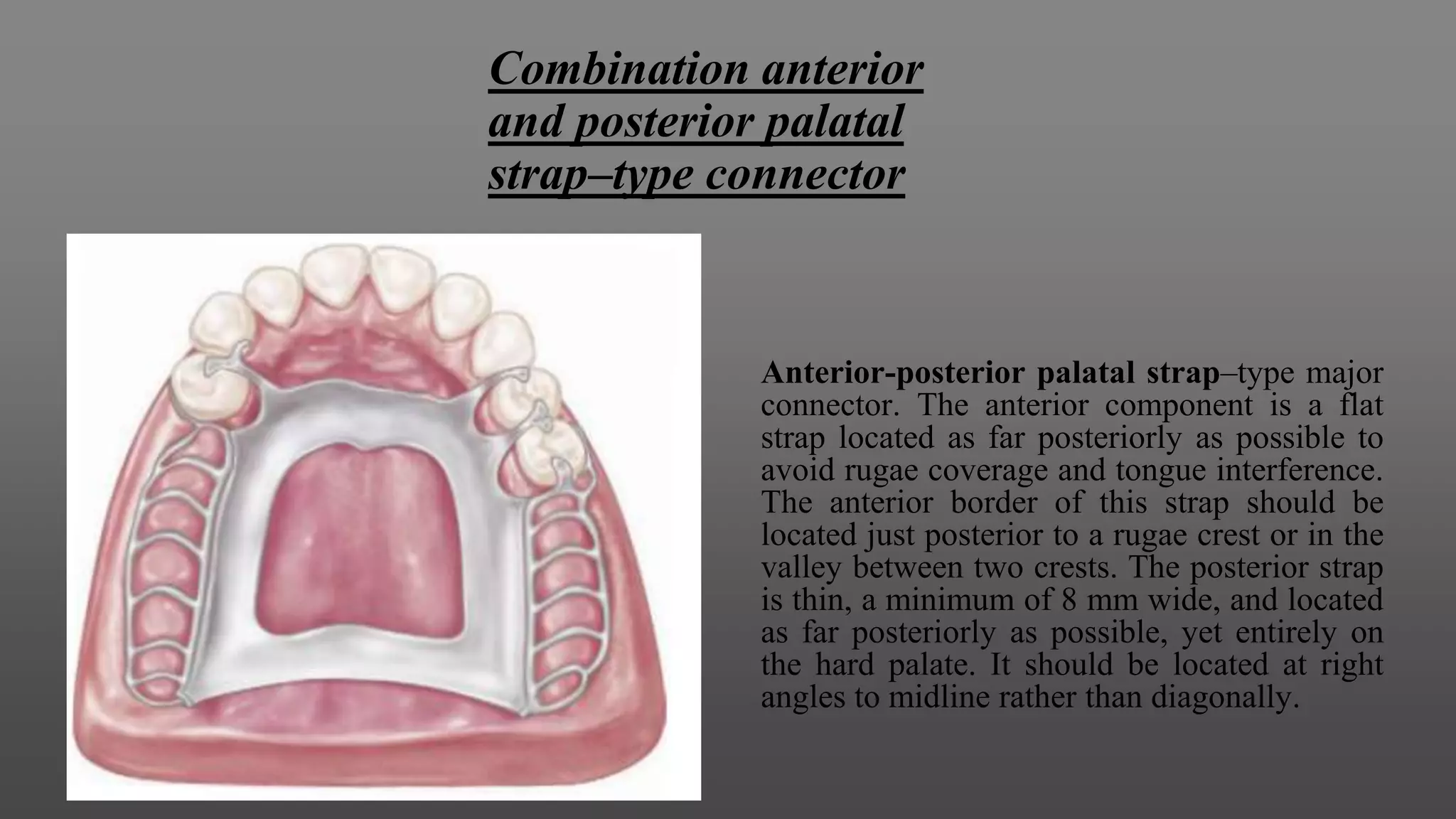 Maxillary major connectors | PPTX