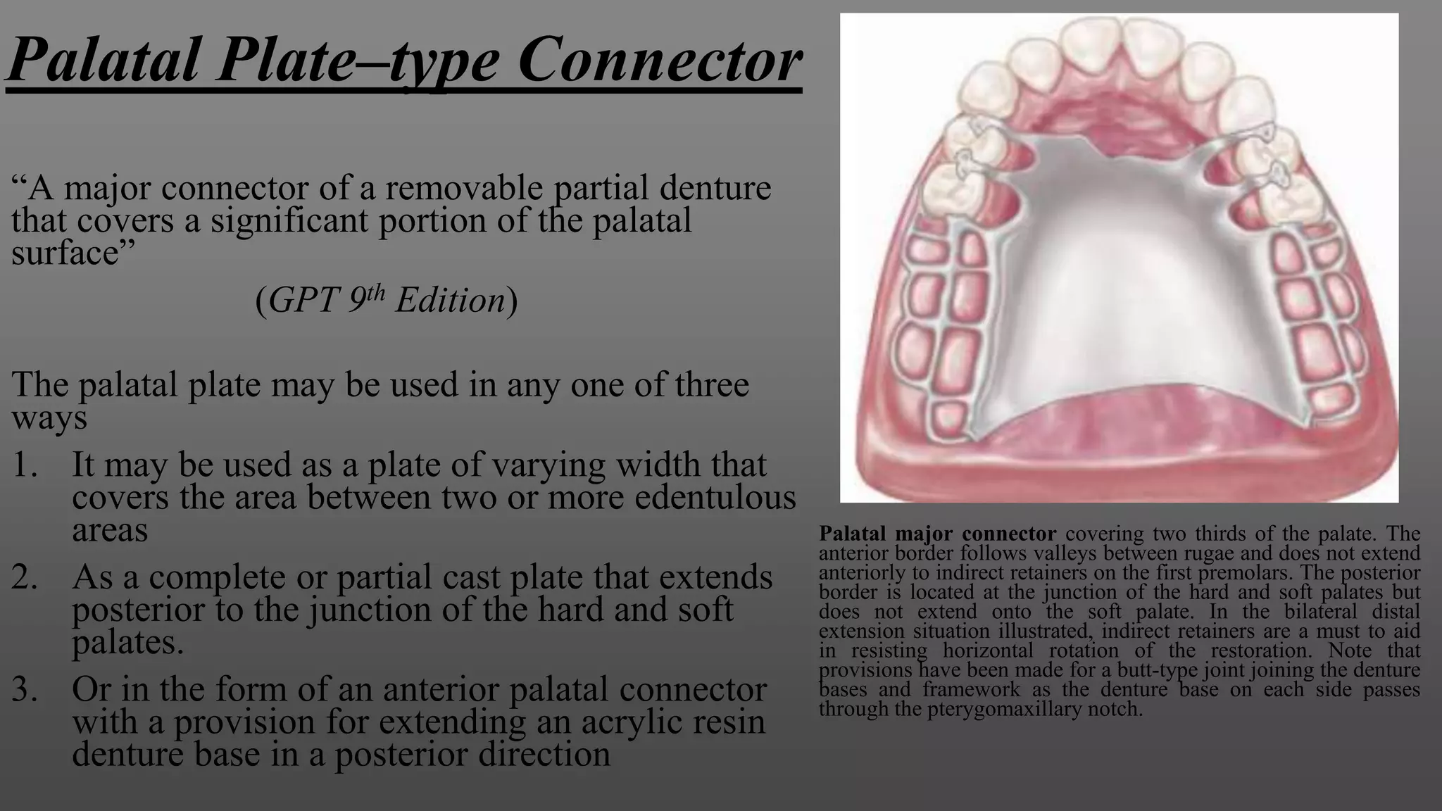 Maxillary major connectors | PPTX
