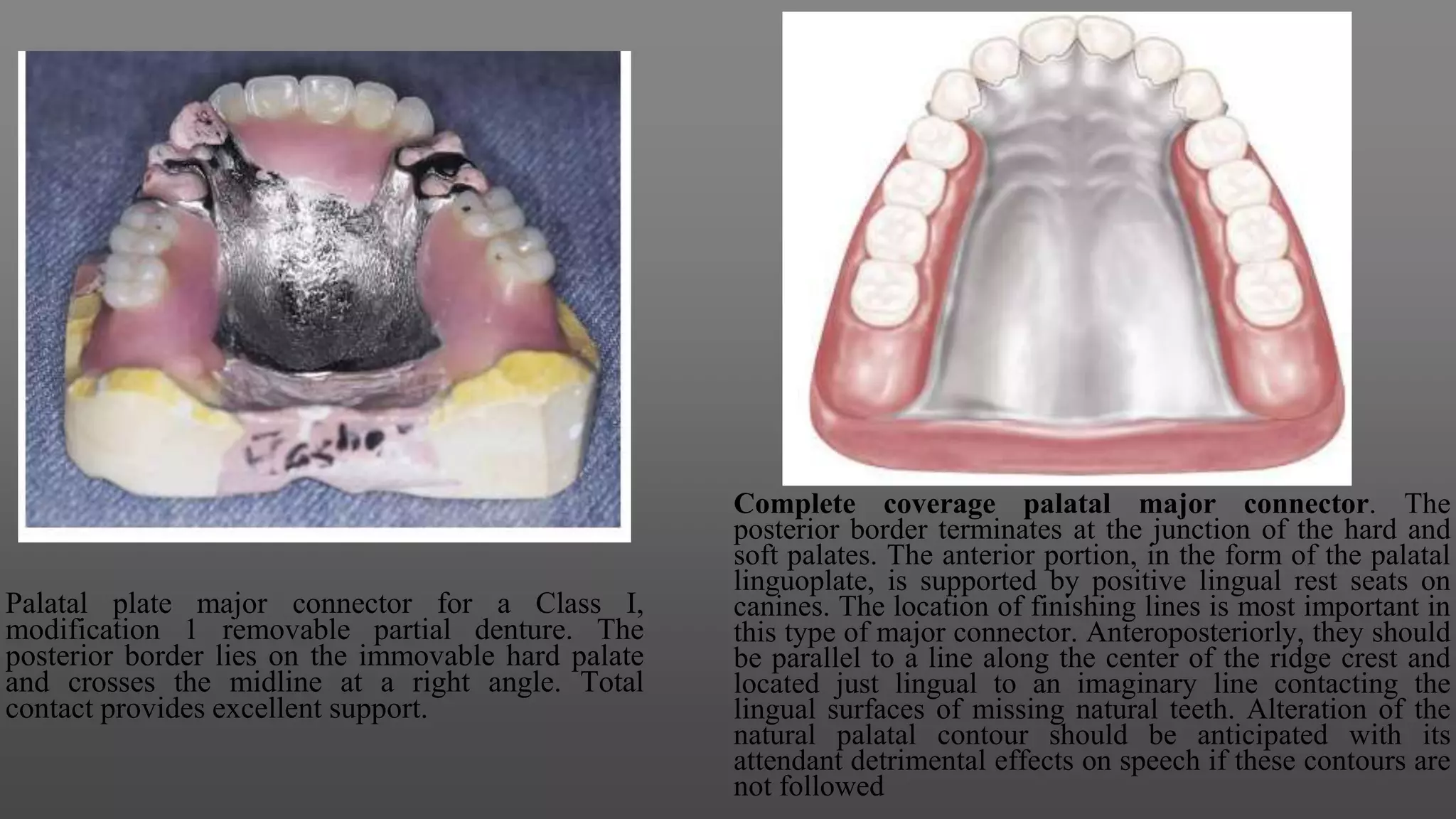 Maxillary major connectors | PPTX