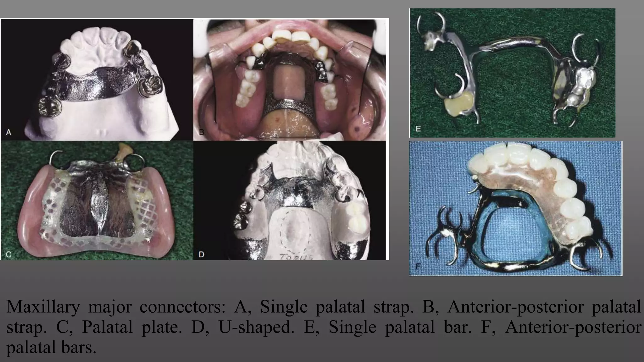 Maxillary major connectors | PPTX