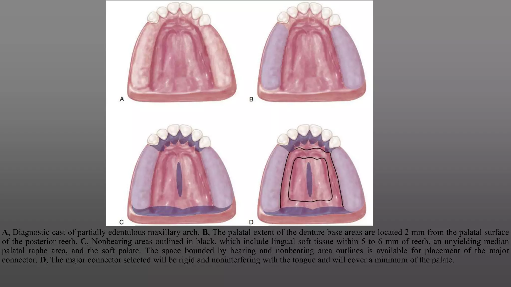 Maxillary major connectors | PPTX