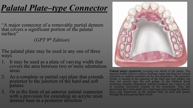 Maxillary major connectors | PPTX