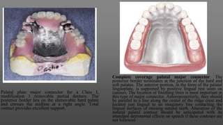 Maxillary major connectors | PPTX