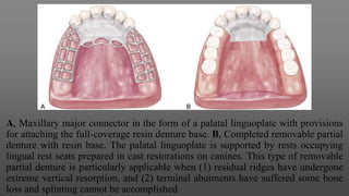 Maxillary major connectors | PPTX