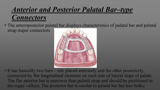 Maxillary major connectors | PPTX