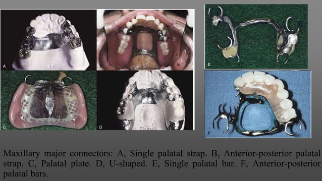 Maxillary major connectors | PPTX